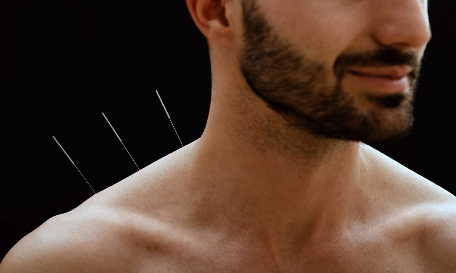Natural Thyroid Treatment with Acupuncture in Edmonton